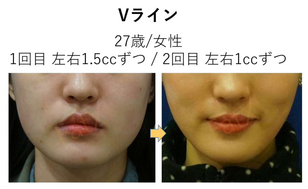 FatX core（脂肪溶解注射） ｜ 白金ビークリニック本院