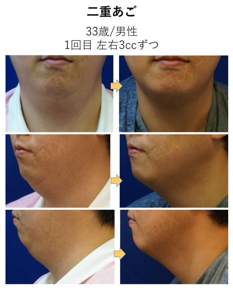 FatX core（脂肪溶解注射） ｜ 白金ビークリニック本院