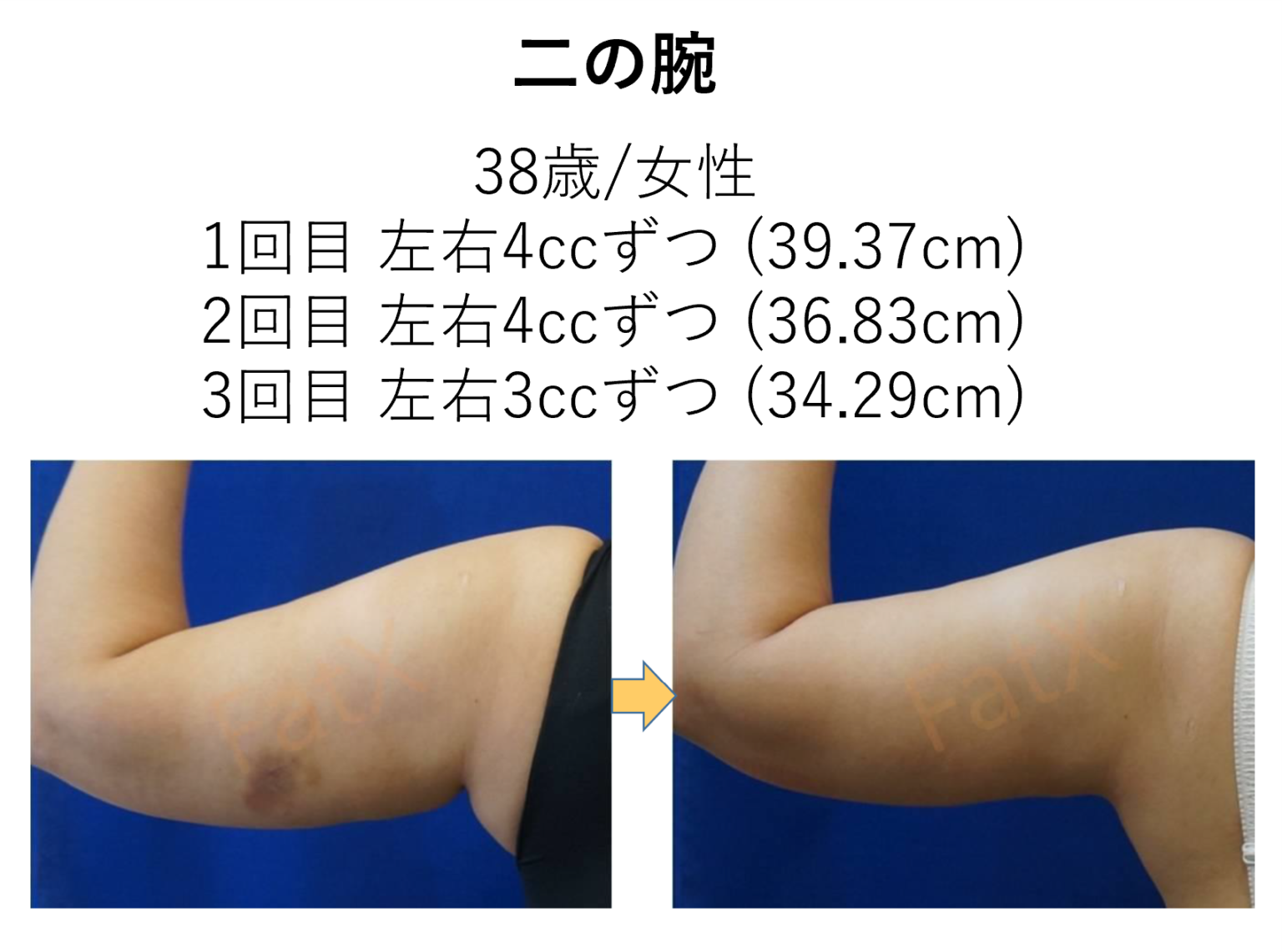 FatX core（脂肪溶解注射） ｜ 白金ビークリニック本院